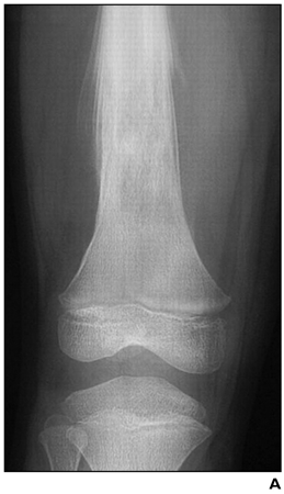 Ewing's Sarcoma - Pathology - Orthobullets